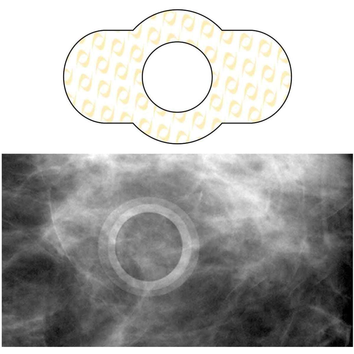 Radiology Skin Marker Spee-d-ring™ Printed Circle Mole – BeHope
